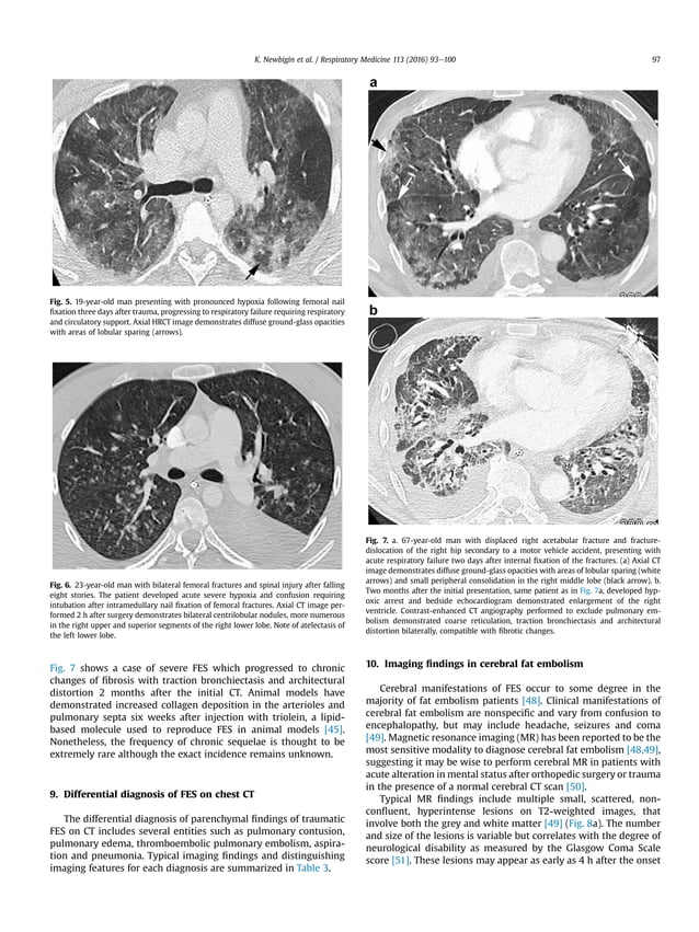 Fat embolism syndrome state of-the-art review focused on | PDF