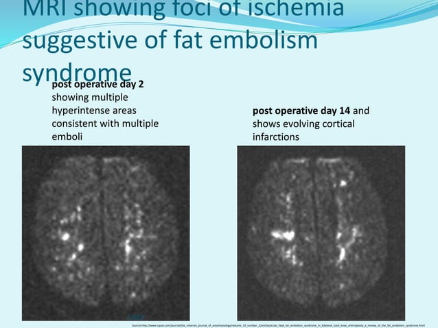 Fat emboli syndrome | PPT