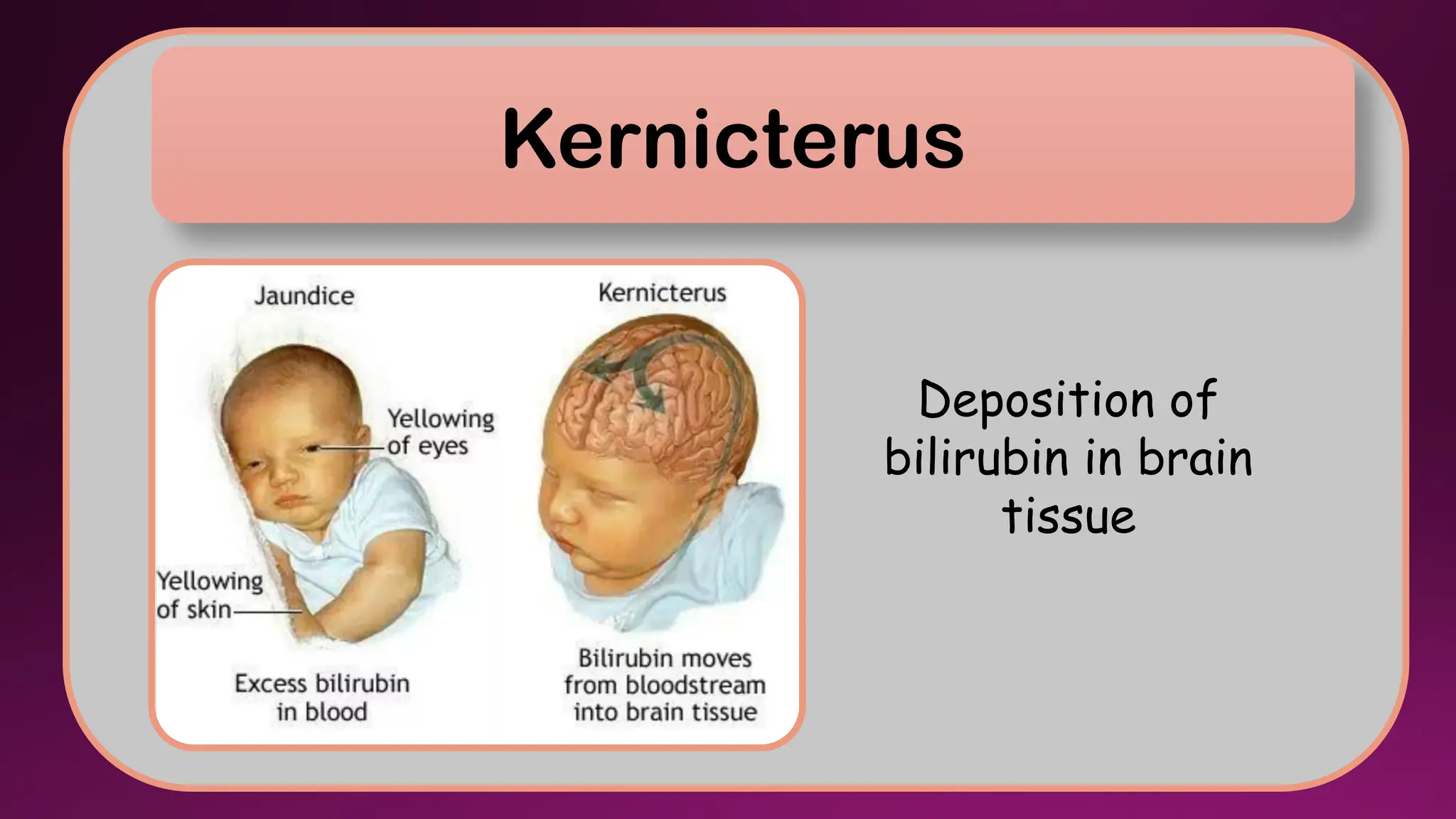 Fate of Hemoglobin and types of Jaundice | PPTX