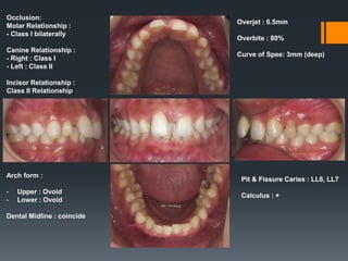 missing laterals | PPTX