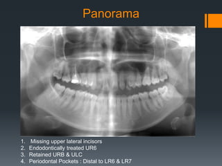 missing laterals | PPT