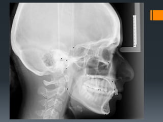 missing laterals | PPTX