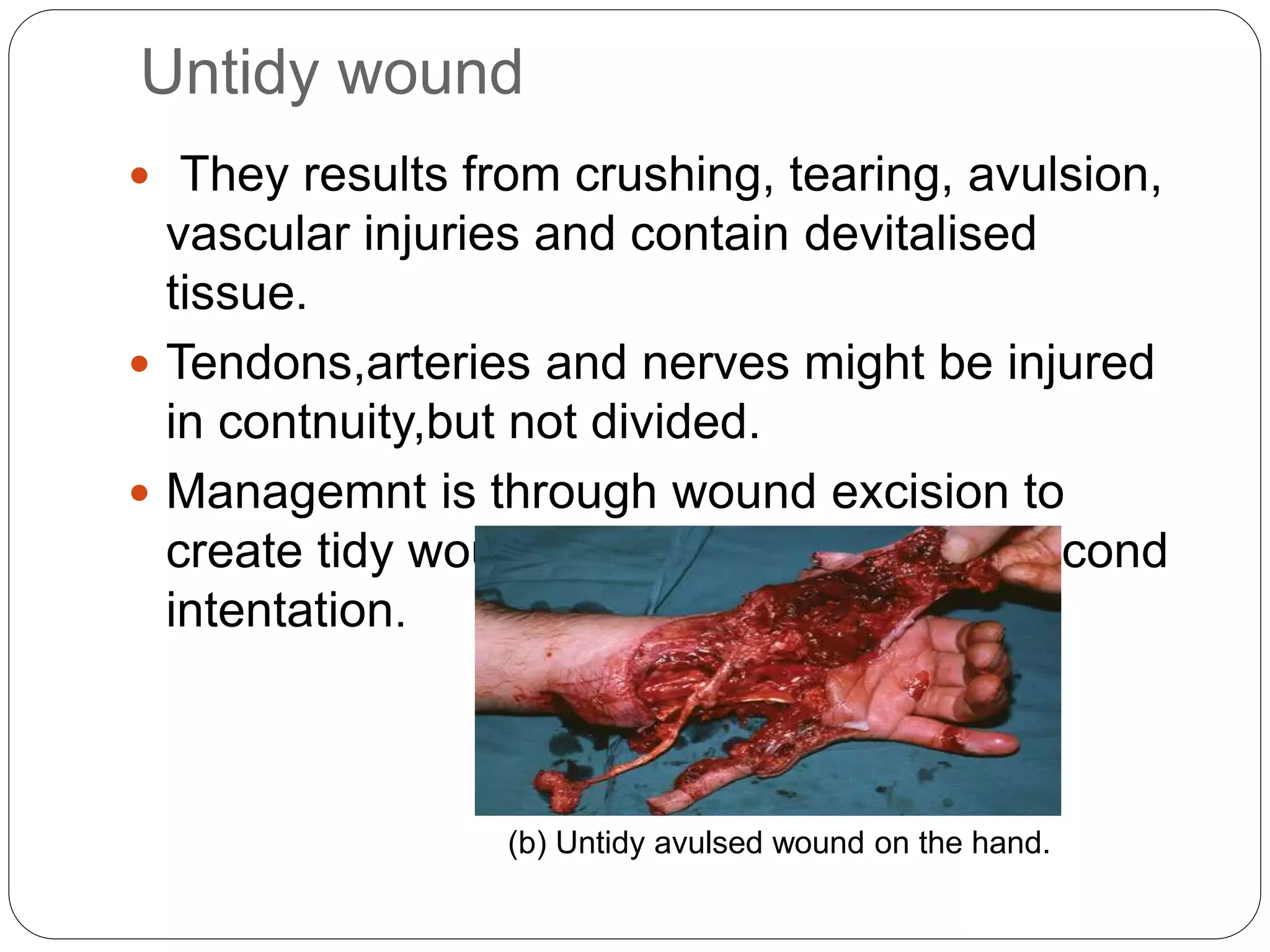 wound healing &ulcer classification | PPTX