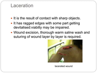 wound healing &ulcer classification | PPT