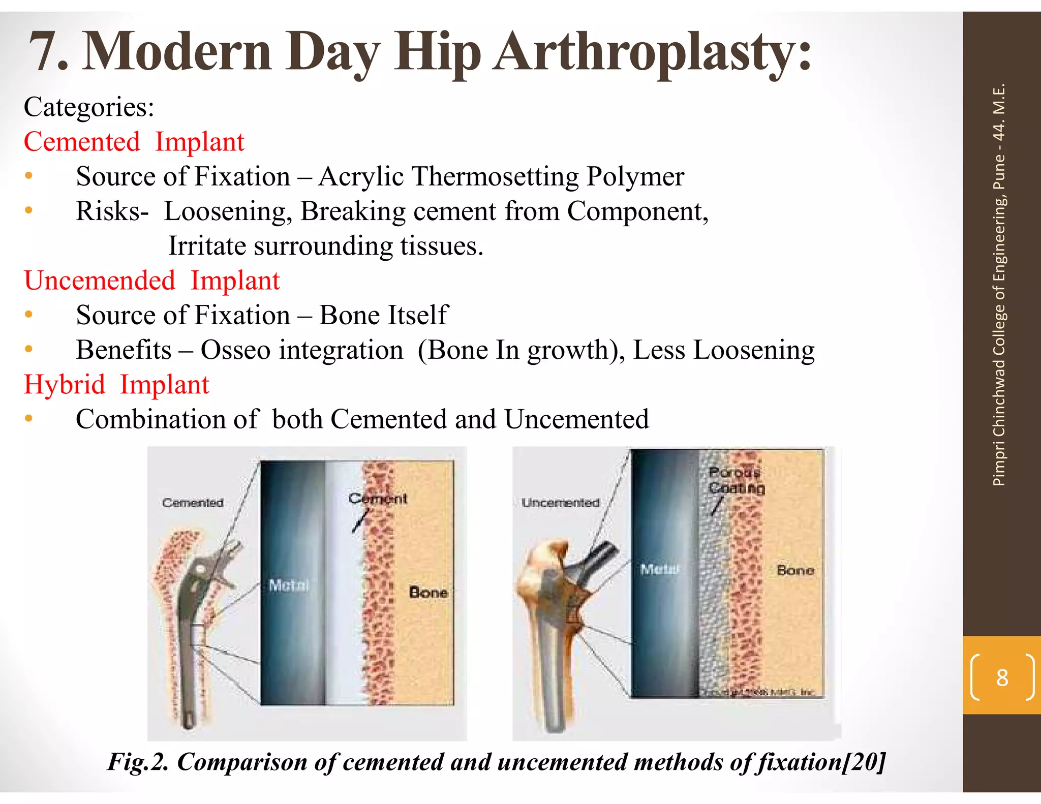 Fatigue life estimation of Human artificial hip joint based on modeling and simulation | PPT