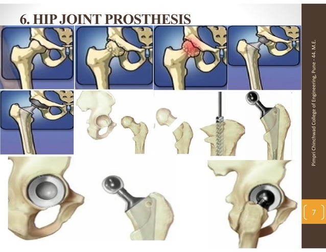 Fatigue life estimation of Human artificial hip joint based on modeling and simulation | PPT