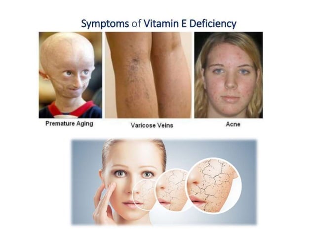 Fat soluble vitamins- structure, rda, functions, sources, deficiency ...