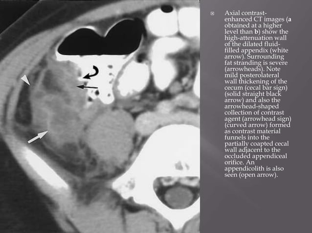 Fat stranding | PPTX