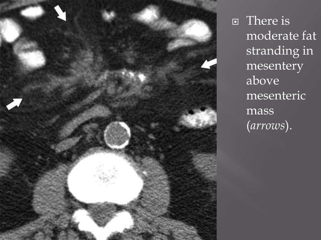 Fat stranding | PPTX
