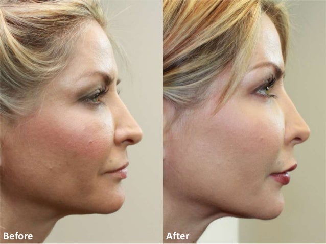 Fat Transfer Breast Augmentation Before After Cosmetic