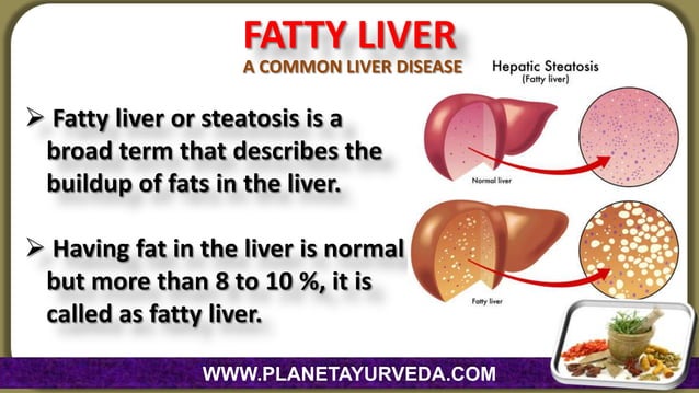 Fatty liver natural cure | Fatty liver ayurvedic treatment | PPT