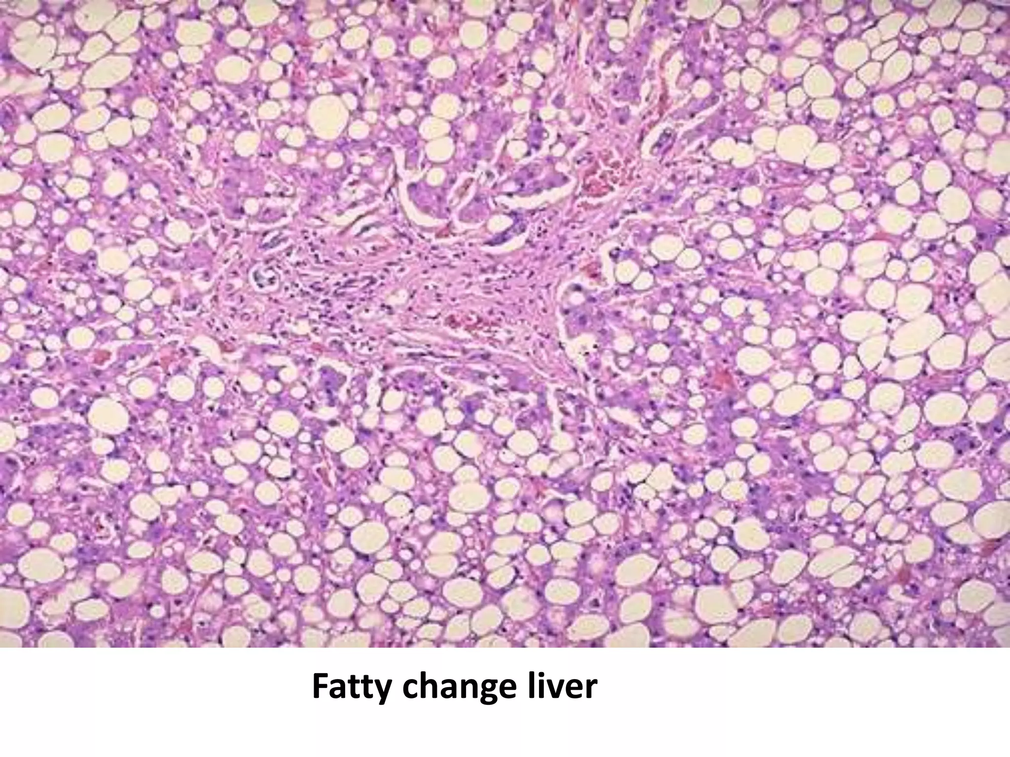 Fatty liver.ppt
