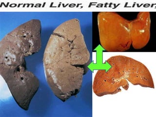 Fatty liver.ppt
