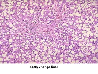 Fatty liver.ppt