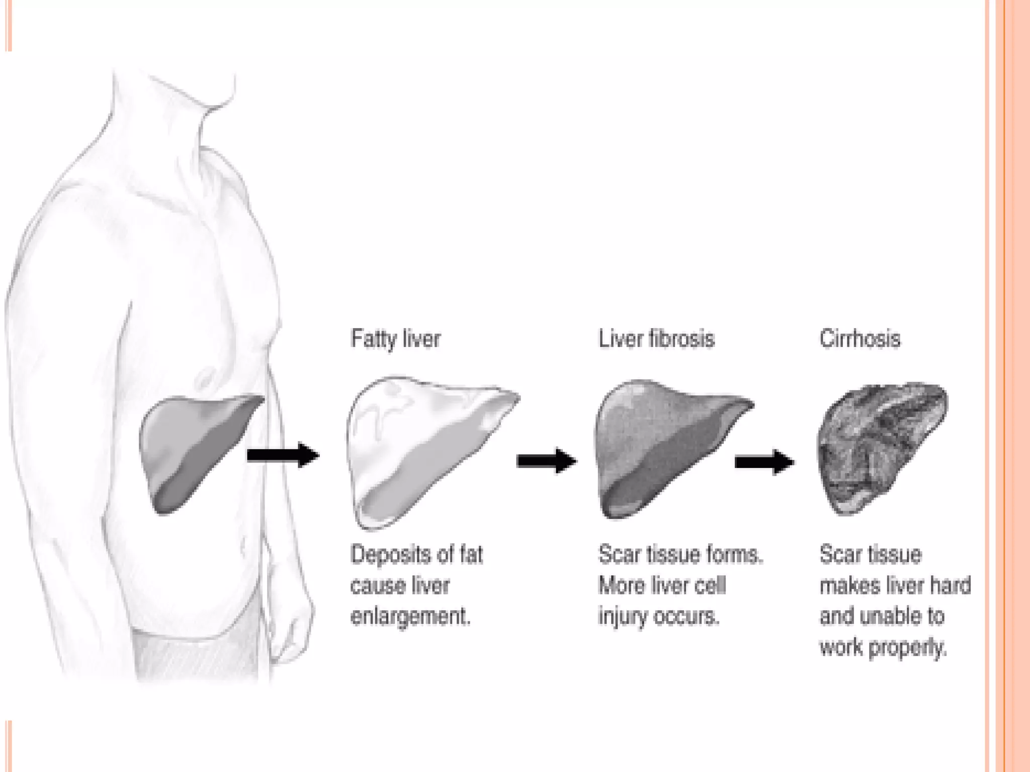 Fatty liver biochemistry by Dr. Anurag Yadav | PDF