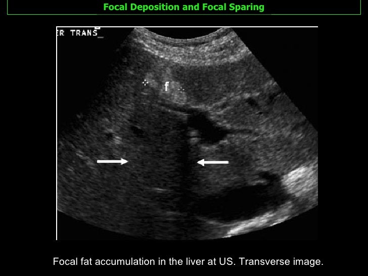 Fatty Liver And Pitfall