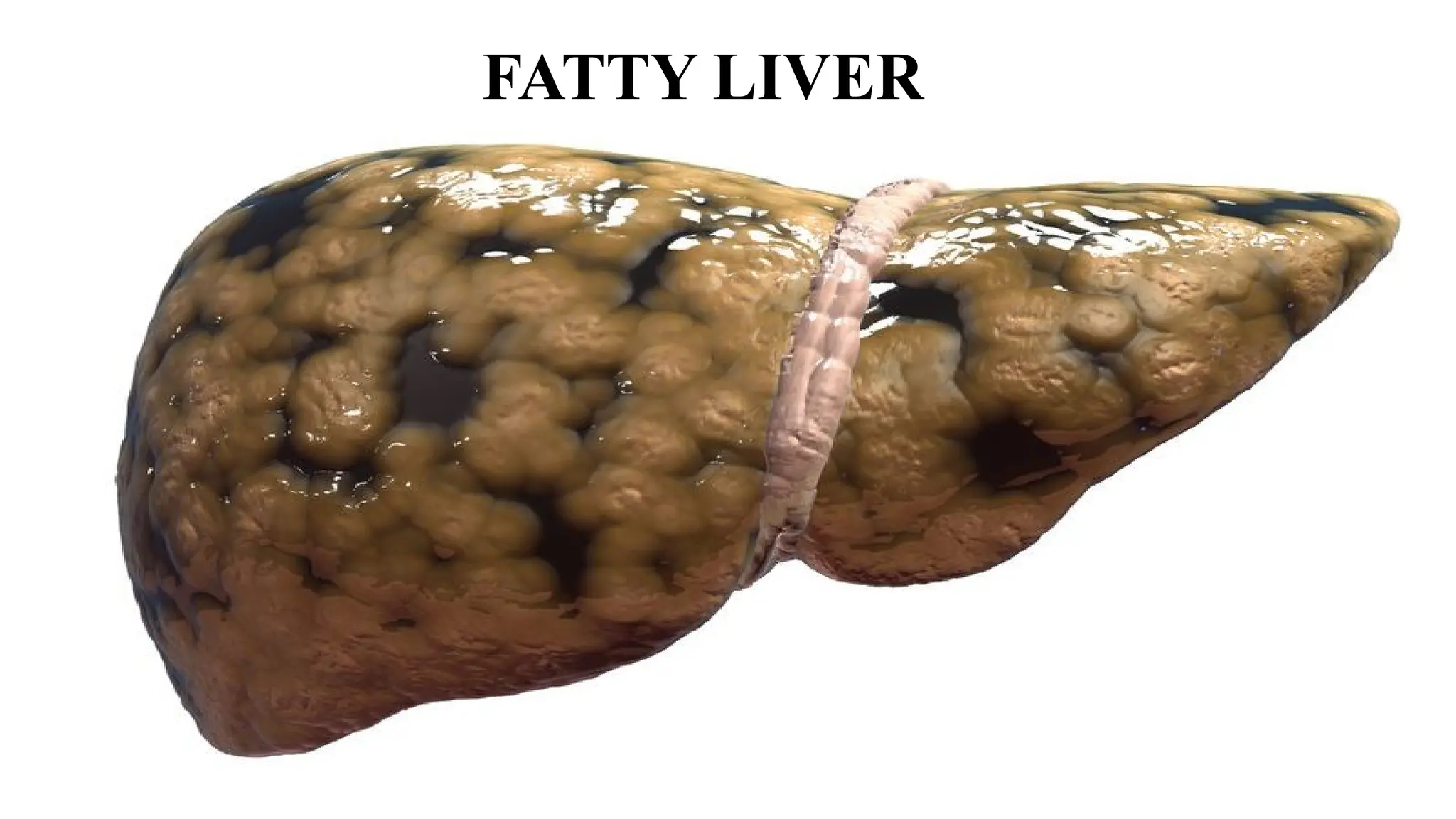 FUnderstanding Fatty Liver: Causes, Risks, and Prevention | PPTX