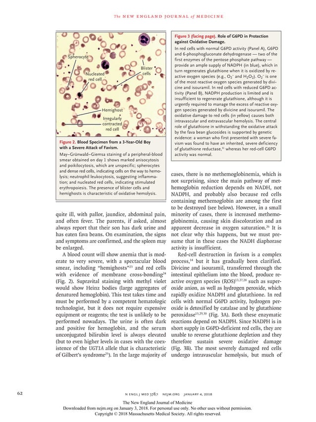 Favism and Glucose-6-Phosphate Dehydrogenase Deficiency.pdf