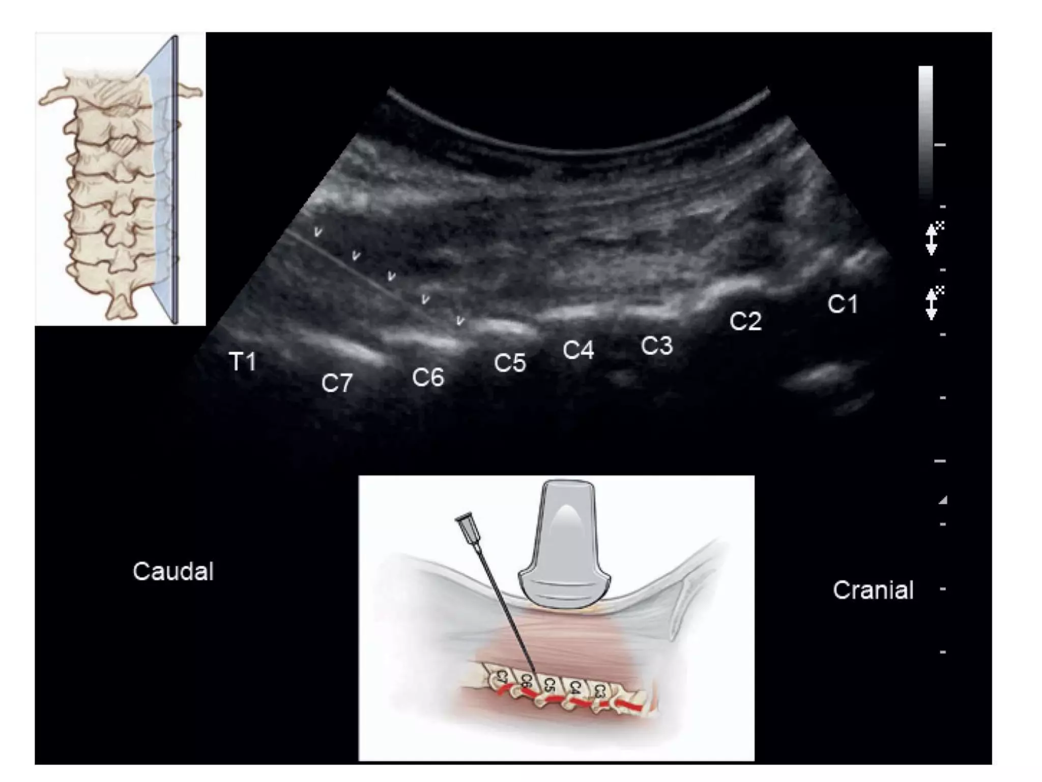Basic sonoanatomy of ultrasound guided interventions of cervical and ...