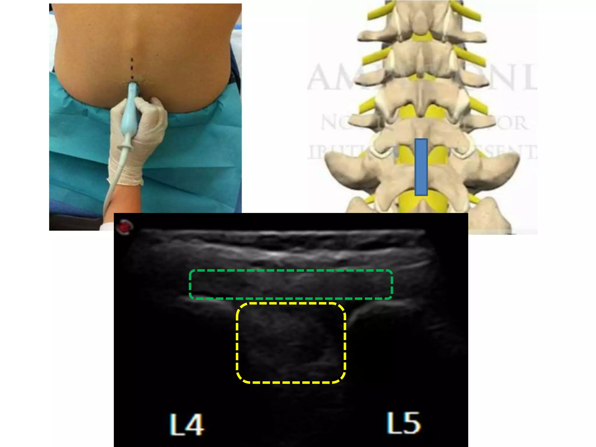 Basic sonoanatomy of ultrasound guided interventions of cervical and ...