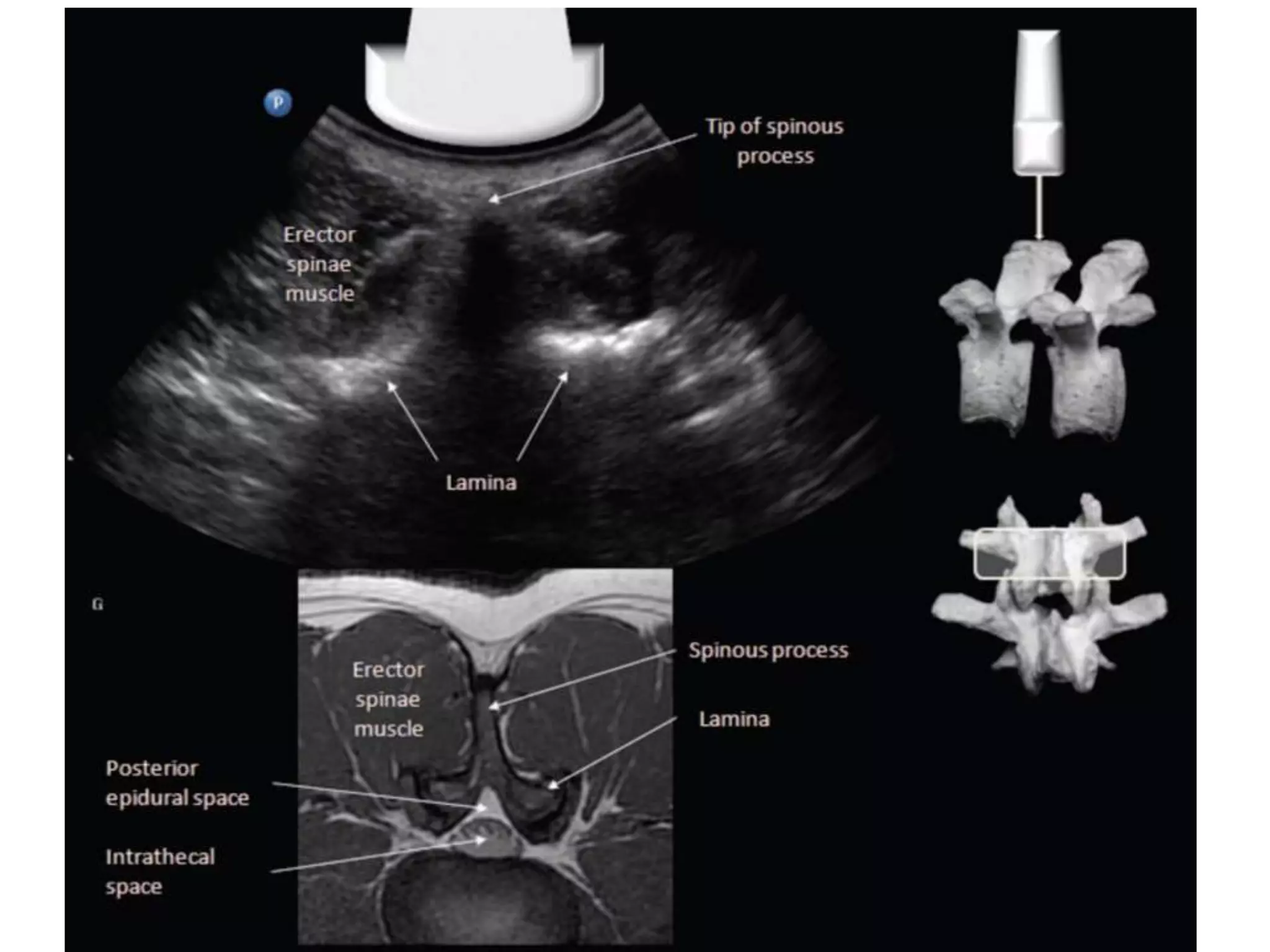 Basic sonoanatomy of ultrasound guided interventions of cervical and ...