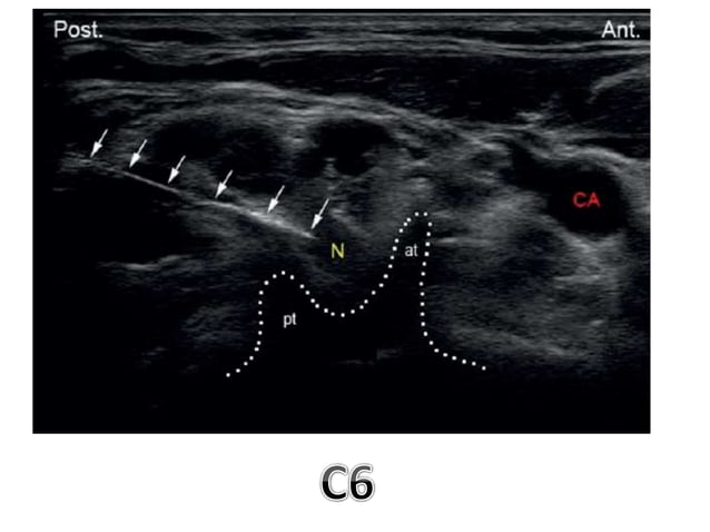 Basic sonoanatomy of ultrasound guided interventions of cervical and ...