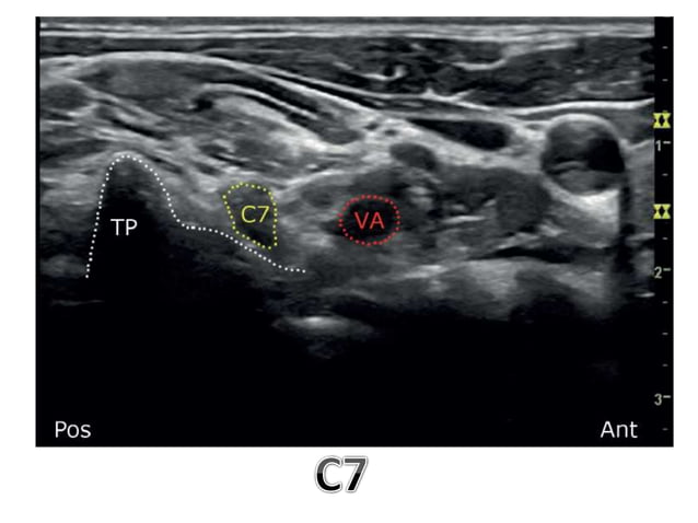 Basic sonoanatomy of ultrasound guided interventions of cervical and ...