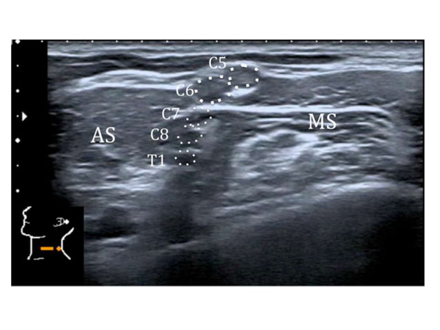 Basic sonoanatomy of ultrasound guided interventions of cervical and ...