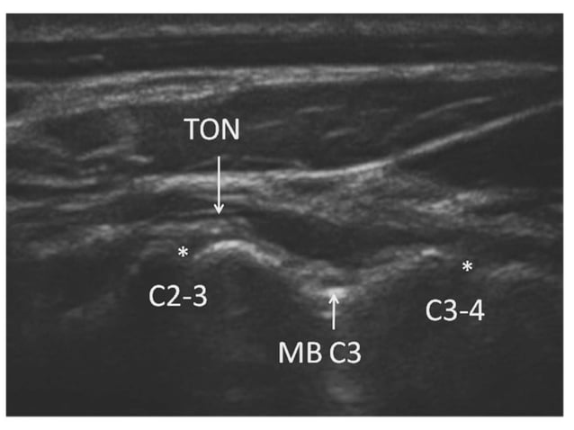 Basic sonoanatomy of ultrasound guided interventions of cervical and ...