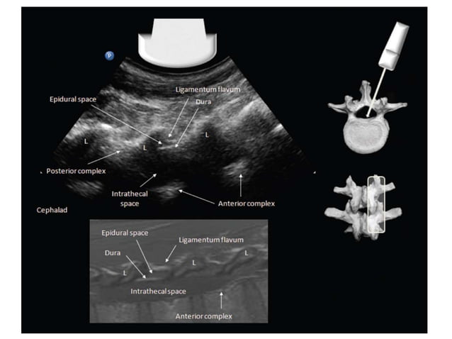 Basic sonoanatomy of ultrasound guided interventions of cervical and ...