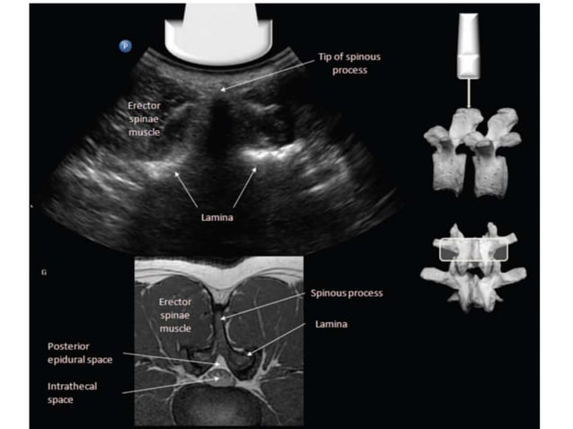 Basic sonoanatomy of ultrasound guided interventions of cervical and ...