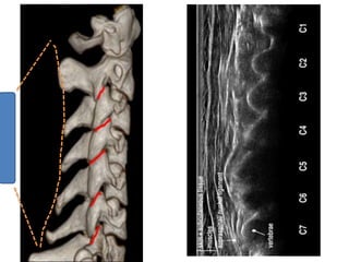 Basic sonoanatomy of ultrasound guided interventions of cervical and ...