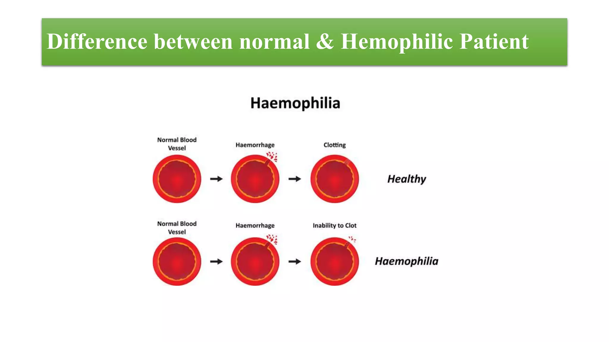 Factor Viii Hemophilia | PPT | Free Download