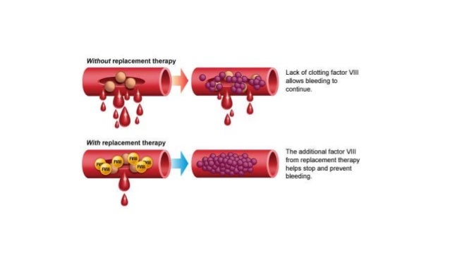Factor Viii Hemophilia