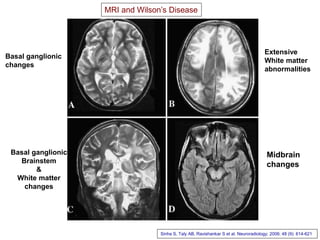 Role Of Mri In Wilson Disease Dr Sanjib Sinha Pptx