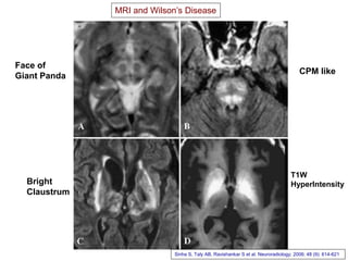 Role of MRI in Wilson disease - Dr Sanjib Sinha | PPTX