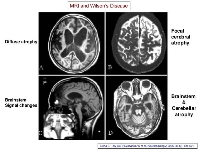 Wilsons Disease Brain Mri