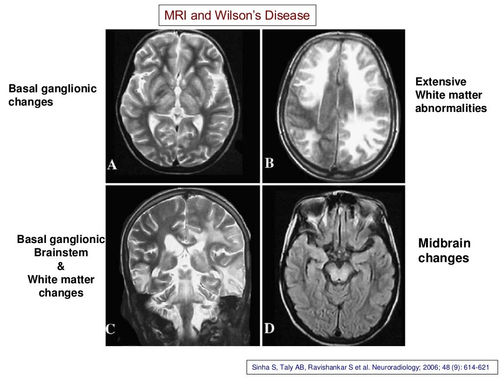 Role of MRI in Wilson disease - Dr Sanjib Sinha