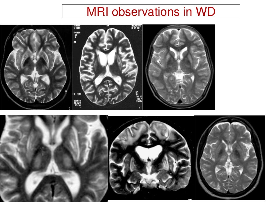 Role of MRI in Wilson disease - Dr Sanjib Sinha