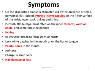Lichen planus bds student | PPTX