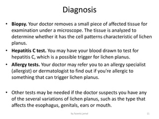 Lichen planus bds student | PPTX