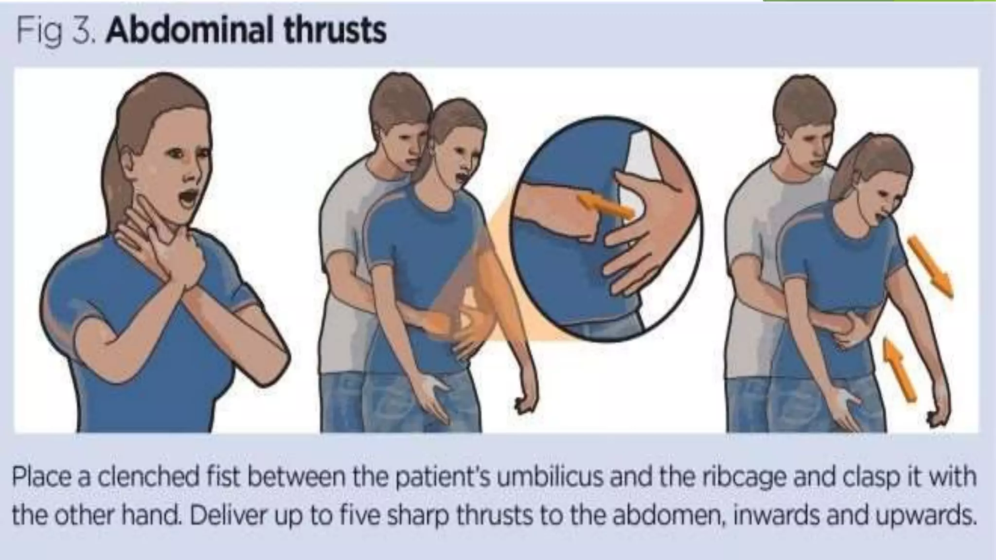 FOREIGN BODY OBSTRUCTION | PPTX