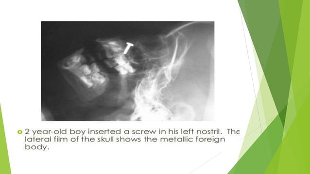 FOREIGN BODY OBSTRUCTION | PPTX