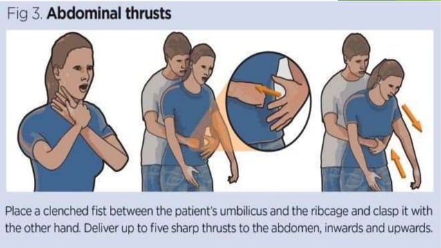FOREIGN BODY OBSTRUCTION | PPTX