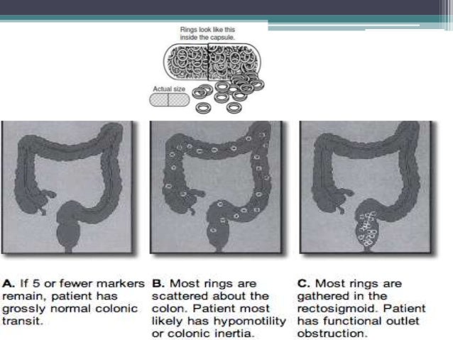 Funtional Bowel Disease