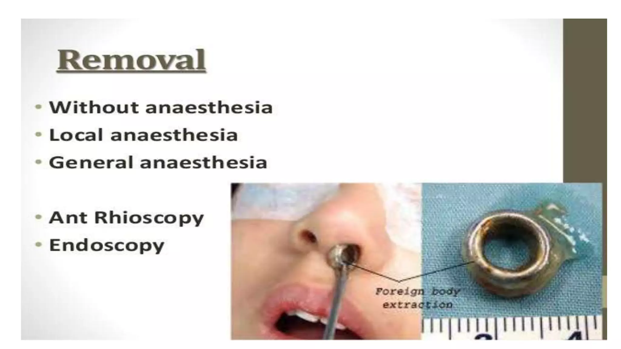 foreign body nose | PPTX