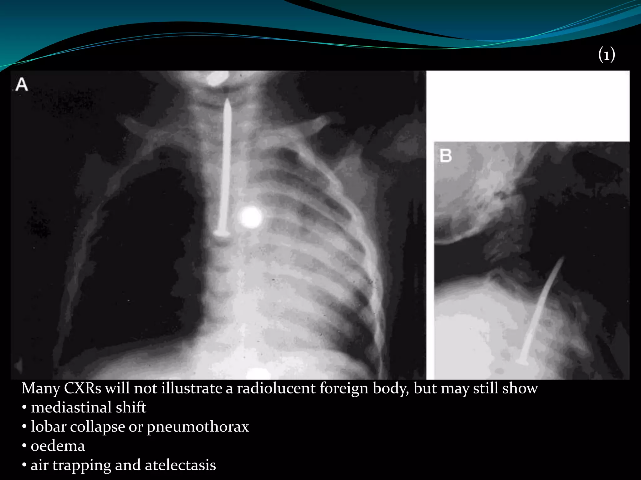 Paediatric Foreign Body Aspiration | PPTX