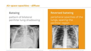 Imaging Of Chest Patholgy Radiology 2024 Pdf