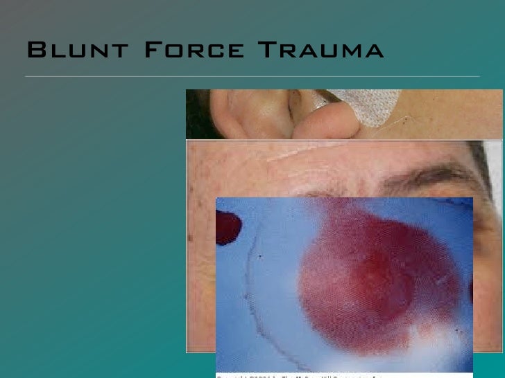 FCA 0111 - Blunt Force Trauma