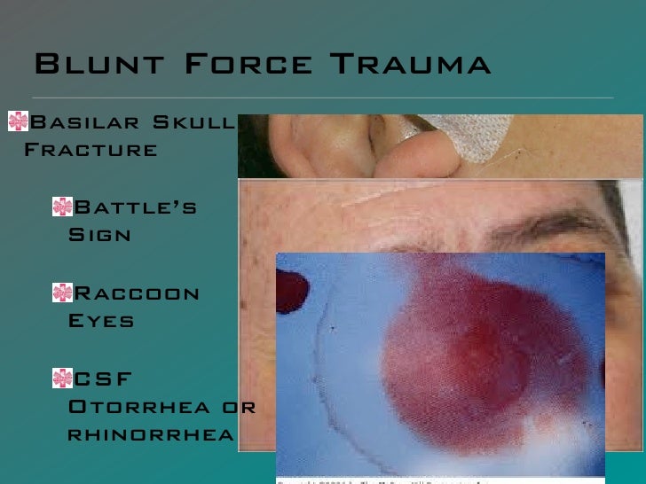 FCA 0111 - Blunt Force Trauma